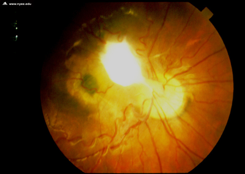 Probable Toxocara Granuloma Nyee